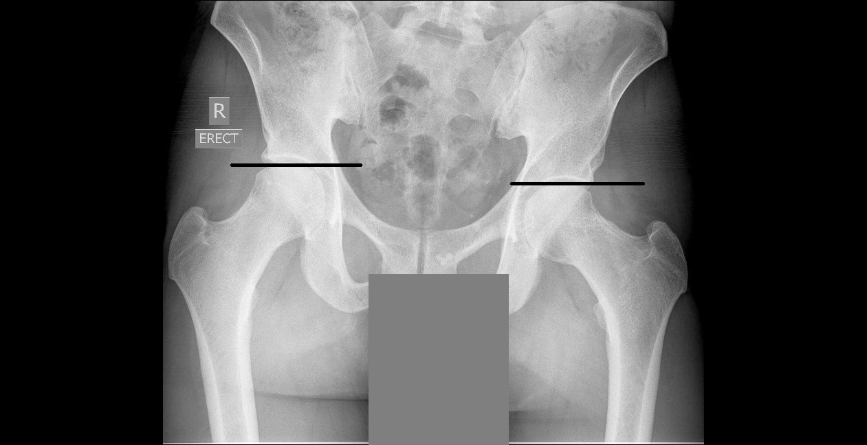 Anatomical Leg Length Discrepancy | Joondalup, Perth Chiropractor ...